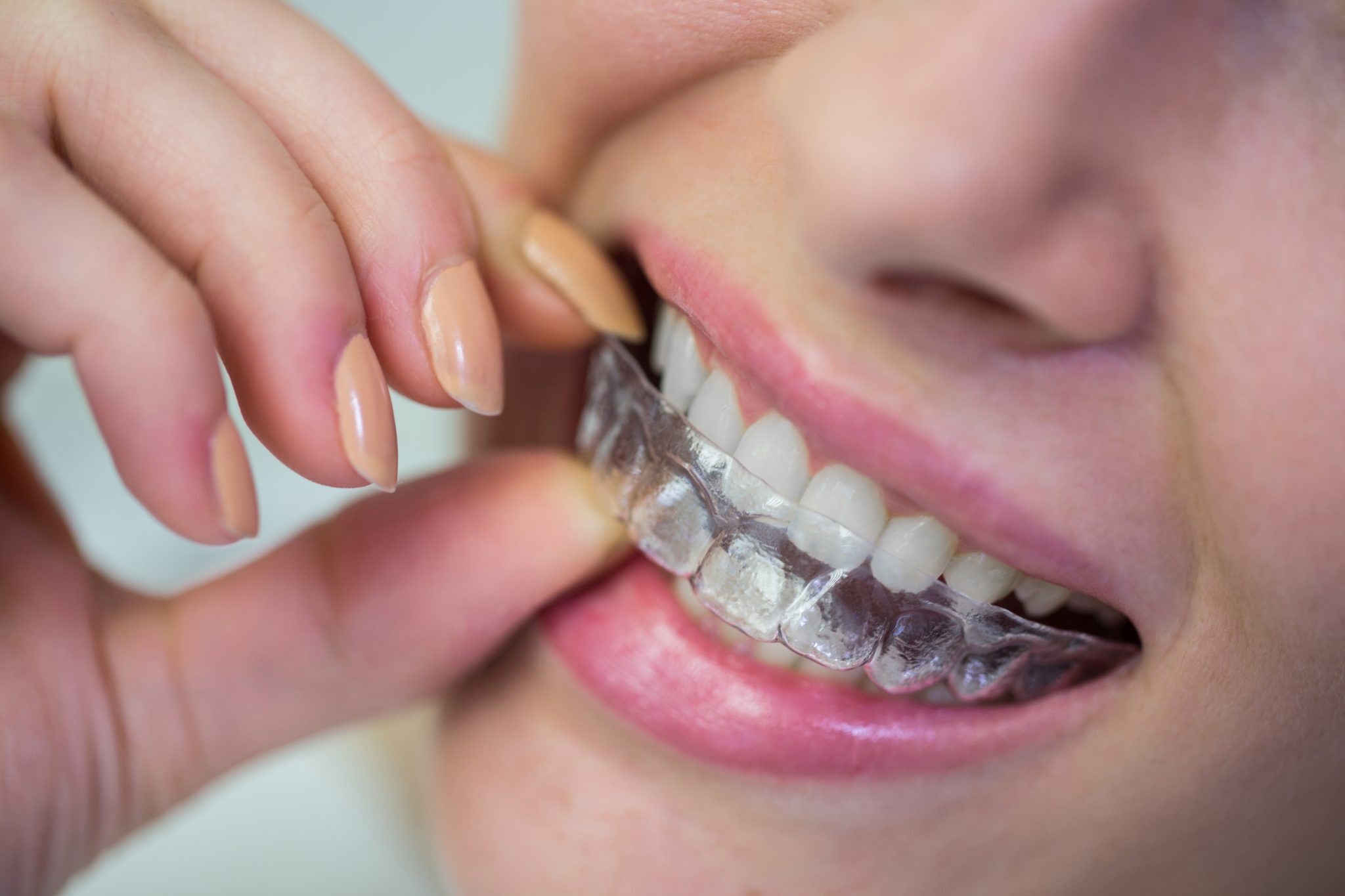 Avulsed Tooth Care: Fast Steps to Save Your Tooth